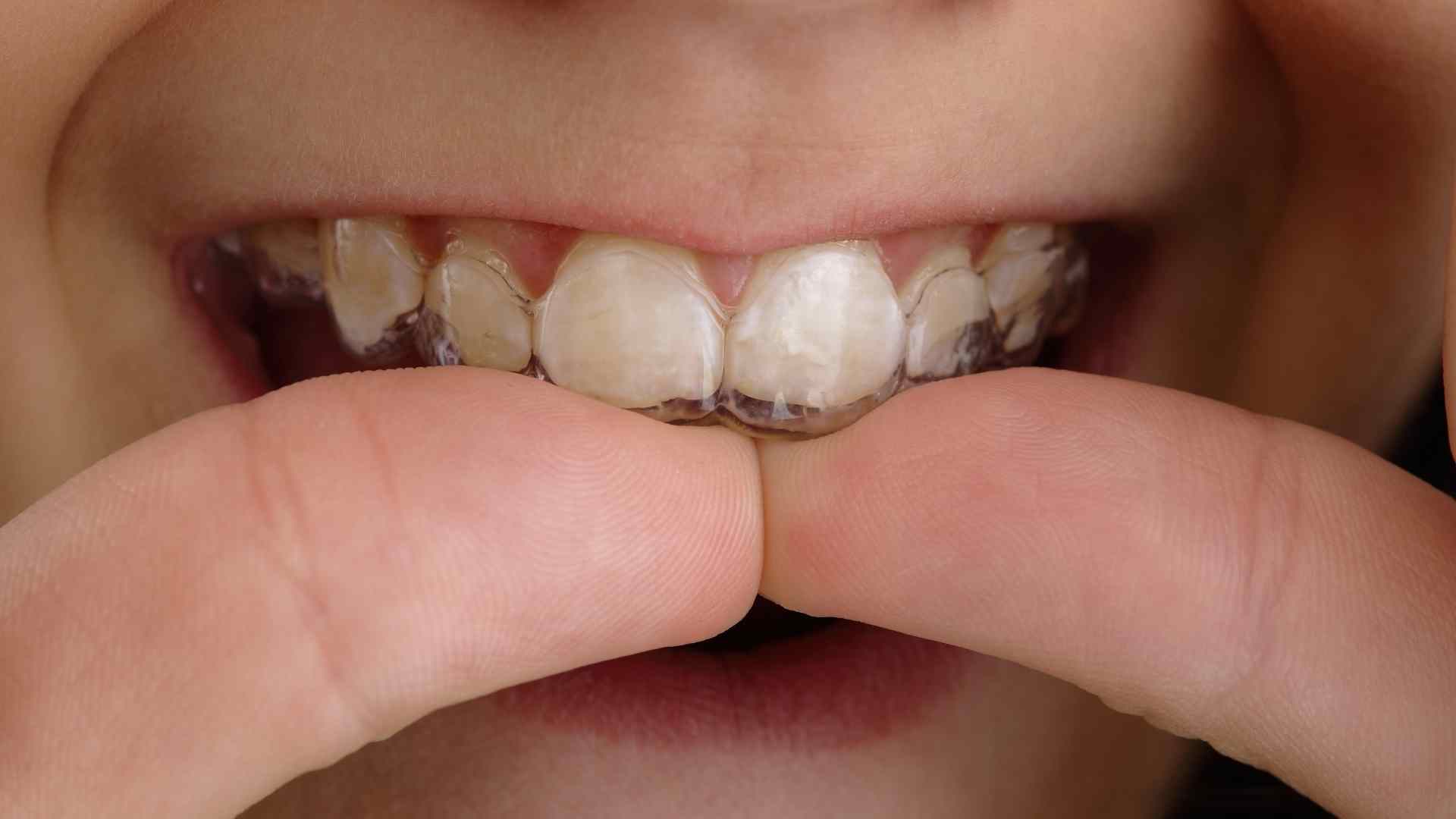Pentingnya Mengenal Retainer Gigi agar Gigi tidak Berantakan – Dokter ...